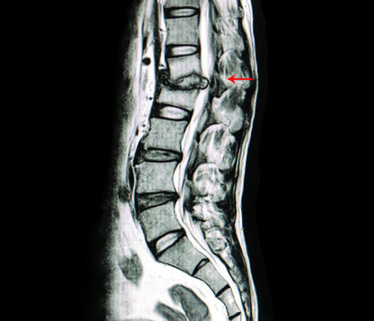 Degenerative Disc Disease | Orthopedic Blog | OrthoCarolina