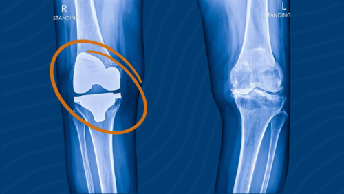 abnormal x ray knee