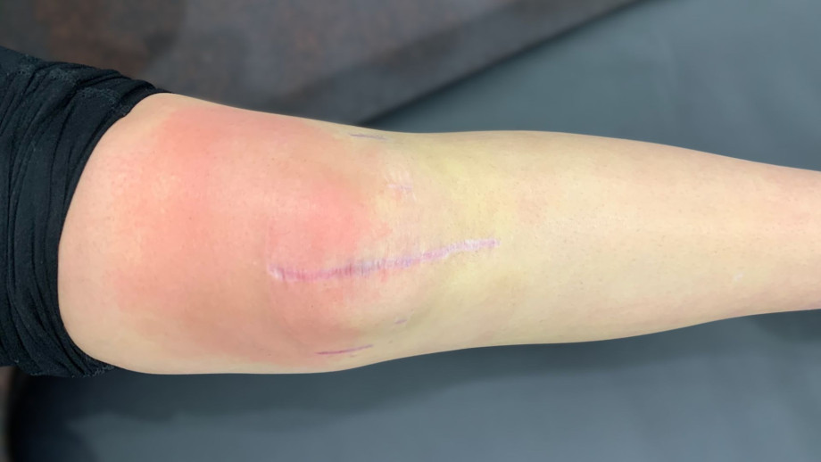 Protecting Scars and Youth Athletes: Expert Sun Care Tips